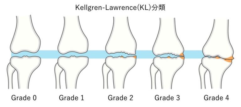 変形性膝関節症のステージ分類（KL分類）と症状・治療法を全解説 | 再生医療クリニック｜リボーンクリニック大阪院